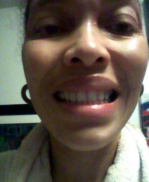 Facing The Lupus Giant: My Lupus Diagnosis - HubPages