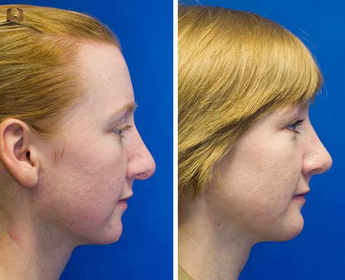 Excessive Scar Tissue | Signs, Symptoms and Treatment - HubPages