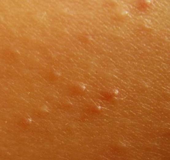 Keratosis Pilaris - Pictures, Treatment, Symptoms and Causes - HubPages
