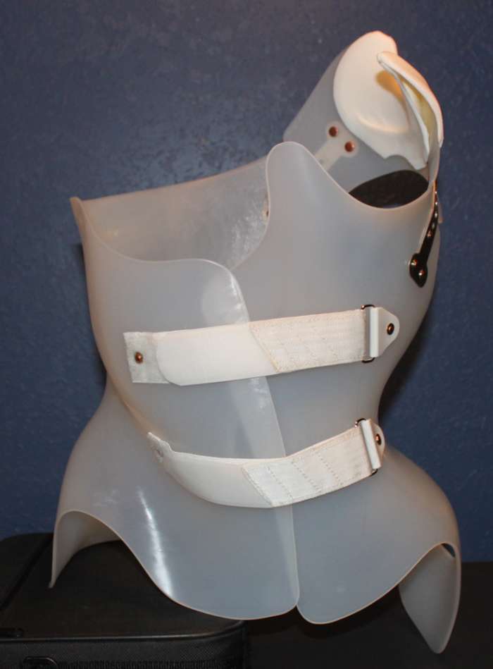 The Schroth Method - A Conservative, Non-surgical Treatment Option for ...