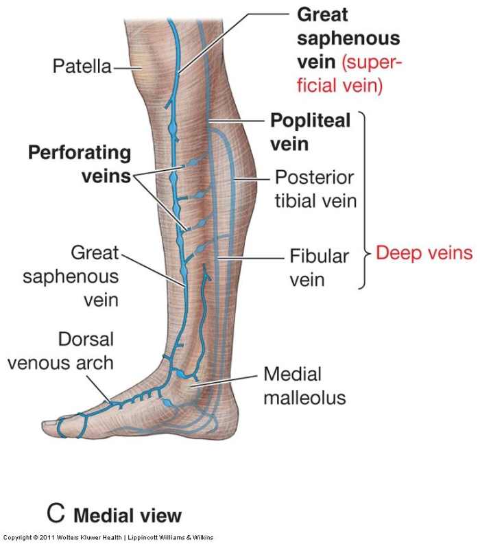 Varicose veins - Their cause,symptoms and cure. - HubPages