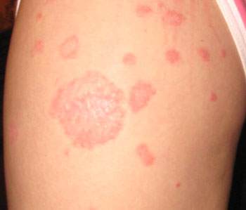 Red Patches on Skin; Causes, Symptoms & Treatment - HubPages