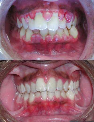 How to treat inflamed gums - HubPages