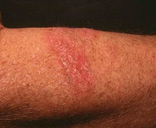 Mycosis Fungoides Pictures Staging Symptoms Treatment And Causes
