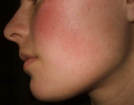 Rash on Face - Treatment, Causes, Pictures - HubPages