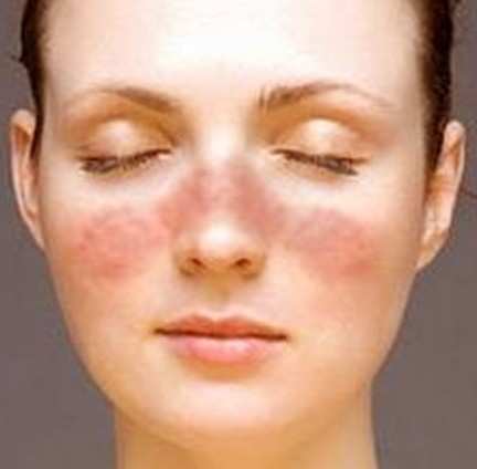 Rash on Face - Treatment, Causes, Pictures - HubPages