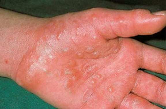 Pompholyx - Pictures, Symptoms, Treatment, Diagnosis, Causes, Cure ...
