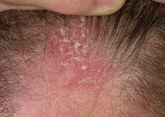 Causes and Treatment for Seborrheic Dermatitis and Related Hair Loss ...