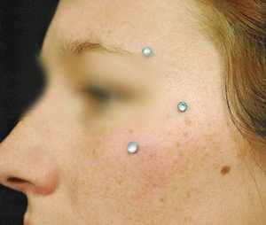 Dermal Piercing: Pictures, Procedure, Aftercare, and Risks - HubPages