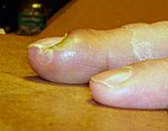 My Experience With Paronychia (Nail Infection) - Patient's Lounge