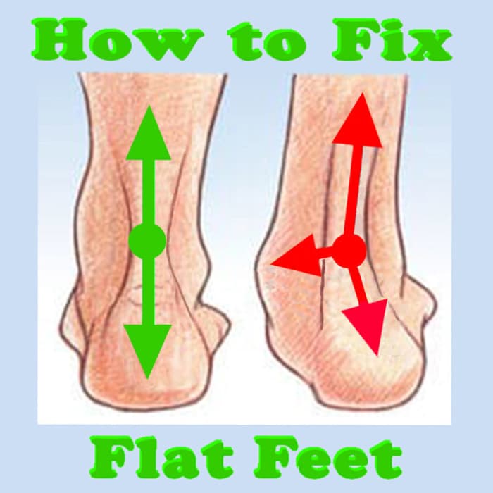 How to Fix Flat Feet (With Targeted Exercises) - HubPages
