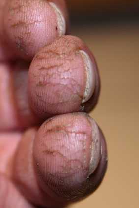 How to Prevent and Treat Cracked Fingers and Fingertips - HubPages