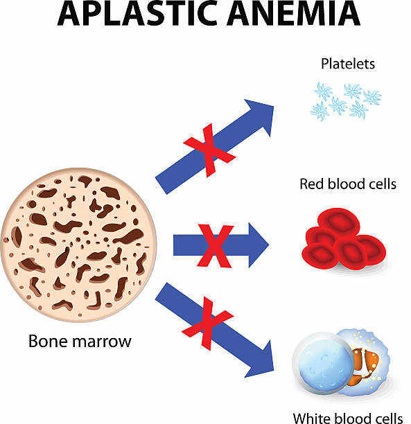 Aplastic Anaemia: A Rare and Serious Blood Disorder Targeting Youths ...