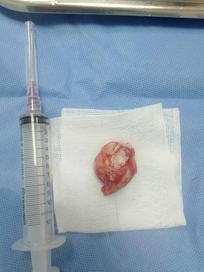 Treatment for My Sebaceous Cyst - HubPages