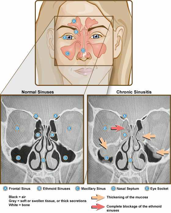 Sinusitis: Types and Causes, Symptoms & Preventions, or Remedies - HubPages