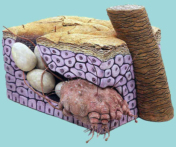 Common Symptoms Of Scabies - HubPages