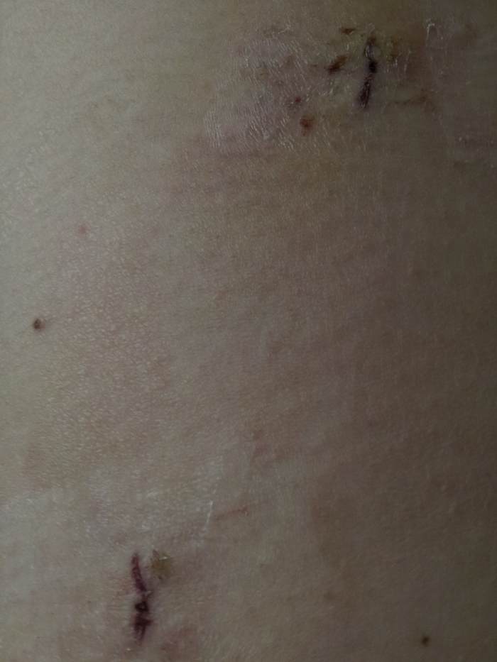 Arthroscopic Hip Surgery and Recovery: My Story - Patient's Lounge