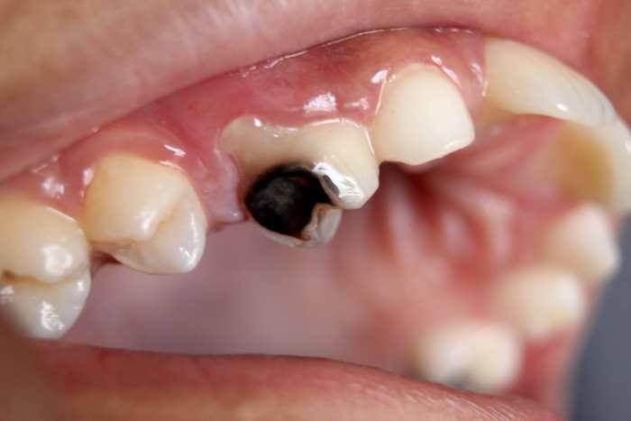 Are Cavities Contagious? How Bacteria Spreads and What to Do - HubPages