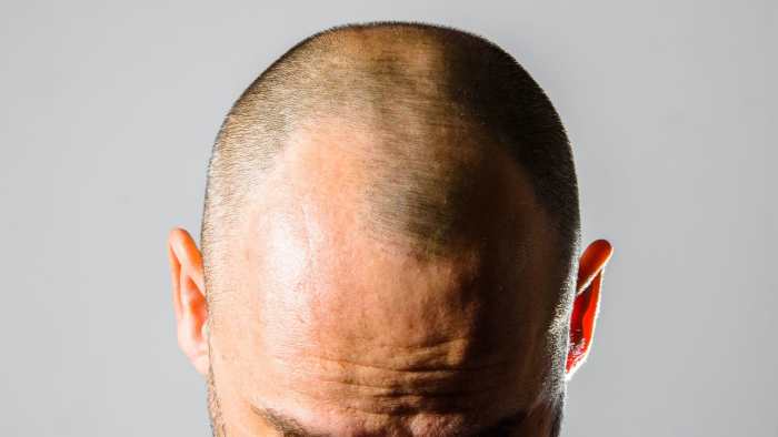 Should I Shave My Head? - HubPages