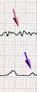 How to Read EKGs – Identifying Atrial Fibrillation - HubPages