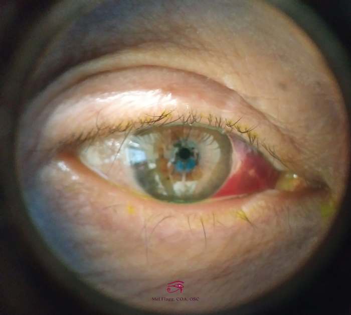 Subconjunctival Hemorrhage: Broken Blood Vessel in the Eye - YouMeMindBody