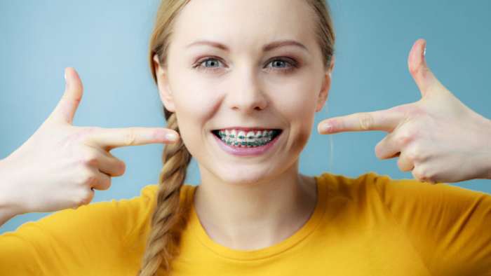 Getting Braces? Prepare In 10 Steps! - HubPages
