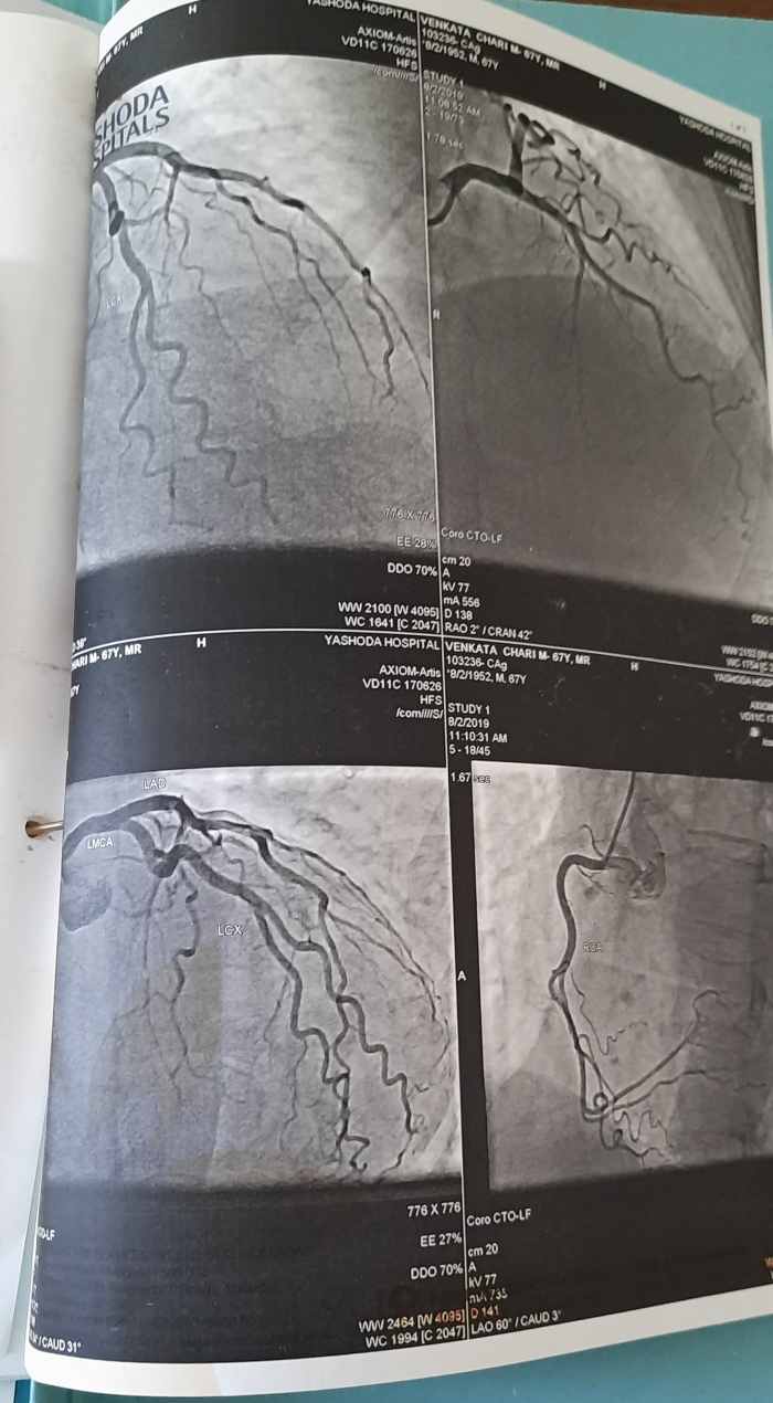 Inside The Heart: My Coronary Angiogram Adventure - HubPages