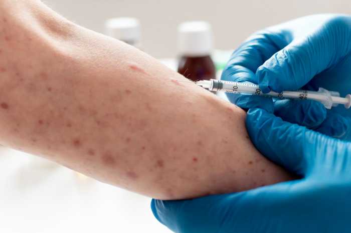 Understanding Monkeypox (Mpox): Symptoms, Causes, and Treatment Explained - HubPages