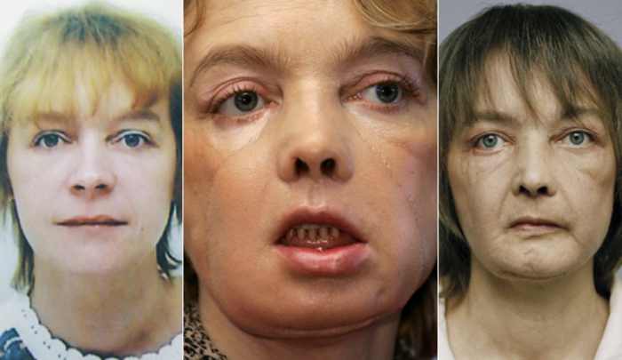 Face Transplants: Medical Miracles - HubPages
