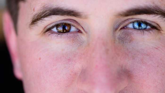 Heterochromia Iridum: People With Two Different Colored Eyes - HubPages
