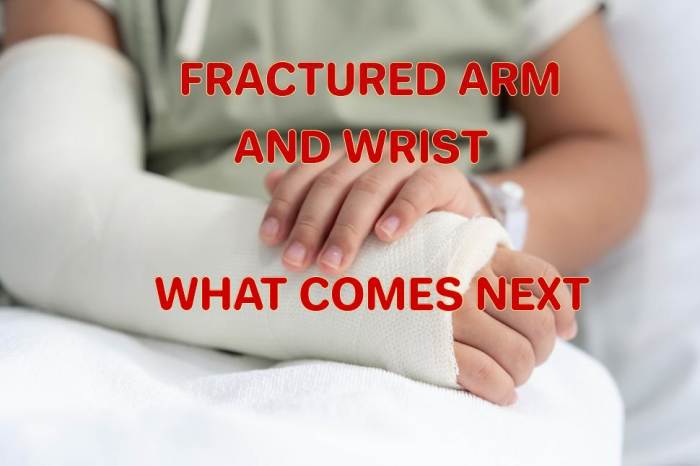 Fractured Arm and Wrist: My Recovery Experience - HubPages
