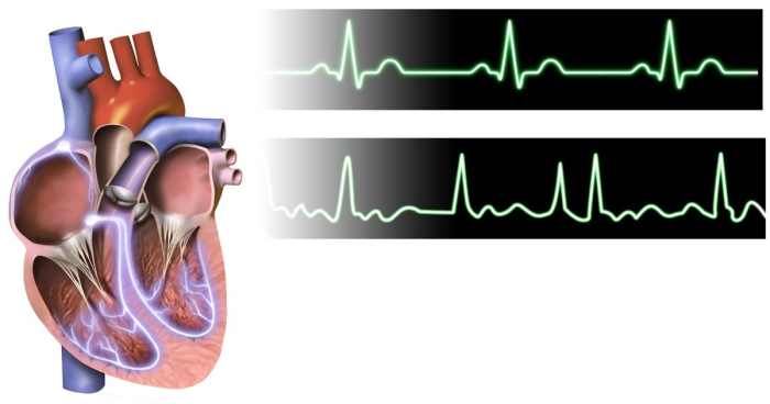 What is Atrial Fibrillation (A-Fib)? - HubPages