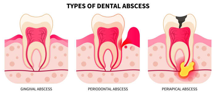 What Is a Tooth Abscess? Symptoms, Causes, and Treatment - HubPages