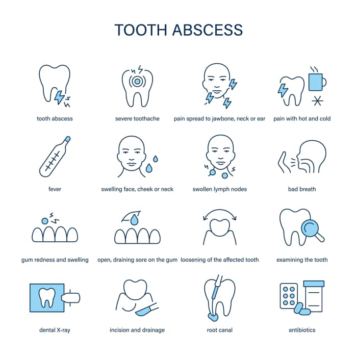 What Is a Tooth Abscess? Symptoms, Causes, and Treatment - HubPages