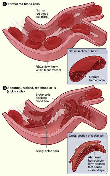 Treatment - Sickle Cell Anemia - HubPages