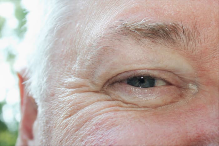 Possible Causes And Home Remedies For Dry Skin Around Your Eyes Youmemindbody Health And Wellness