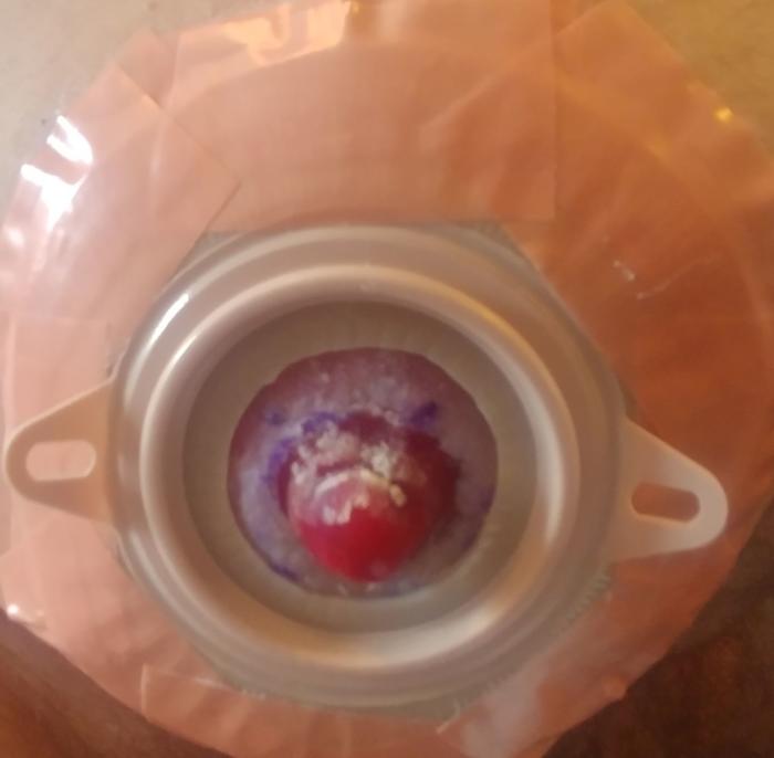 Living With a Urostomy - Patient's Lounge - Patient Medical Experiences