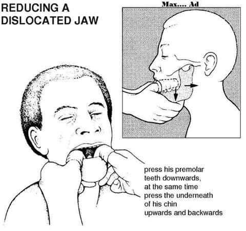Temporomandibular Joint Disorder (TMJ) and Dislocated Jaw - Patient's ...