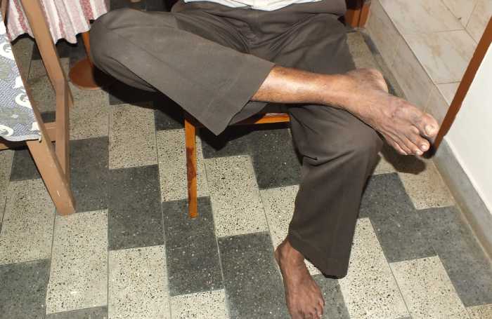 Frenkel’s Exercises for Ataxic Conditions (Cervical Spondylotic ...