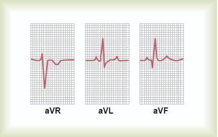How to read a normal ECG(Electrocardiogram)? - HubPages