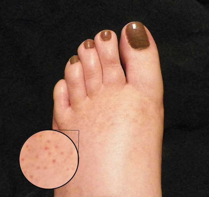 Causes Of Red Dots On Feet HubPages