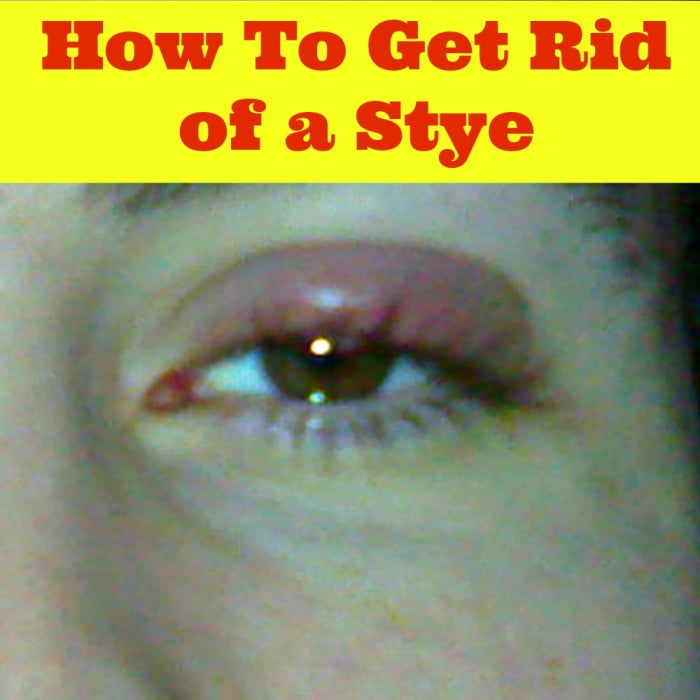 How to Get Rid of a Stye in Your Eye - Eye Stye Treatment - HubPages