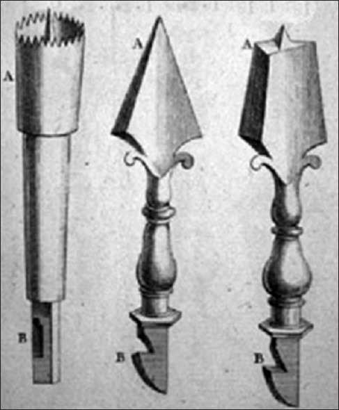 Ice- Pick Lobotomy and A Hole in the Head - HubPages