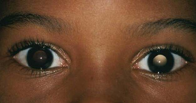 Anisometropia - Symptoms, Causes, Diagnosis, Treatment - HubPages
