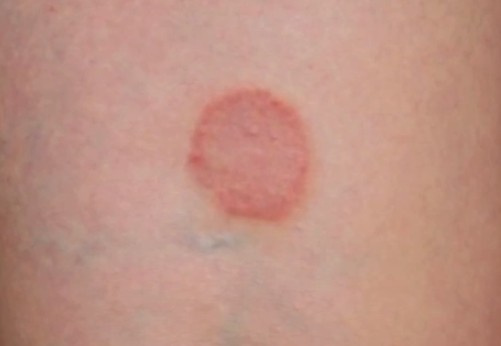 Ringworm – Images, Causes, Symptoms, Treatment - HubPages