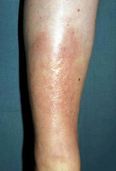 Pretibial Myxedema - Pictures, Treatment, Symptoms, Causes - HubPages