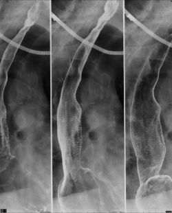 What Is CREST Syndrome? - HubPages