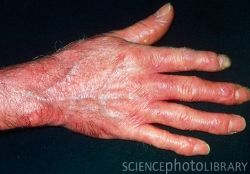 What Is CREST Syndrome? - HubPages