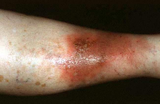 Cellulitis - Pictures, Symptoms, Treatment, Contagious, Causes, Types ...