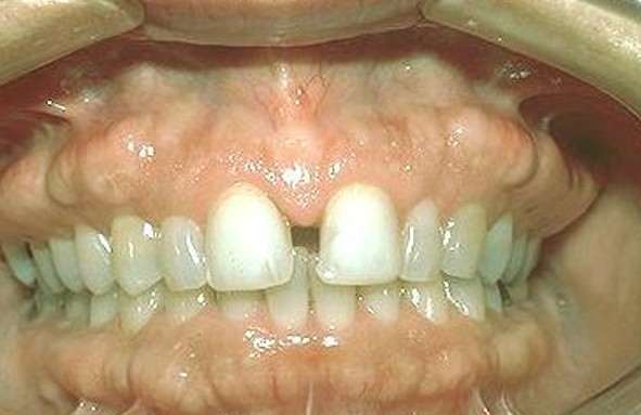 Exostosis - of Foot, Mouth, Ear, Definition, Pictures - HubPages